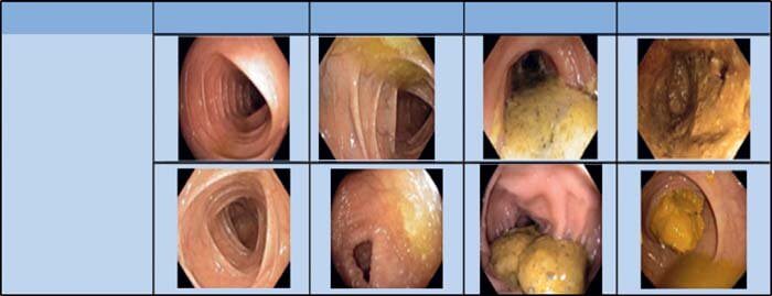 Improving Colonoscopy Prep and Achieving Better Boston Bowel Preparati ...