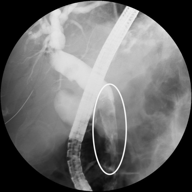 Abdominal Pain, Jaundice and Melena – Think of Hemobilia – EndoCollab