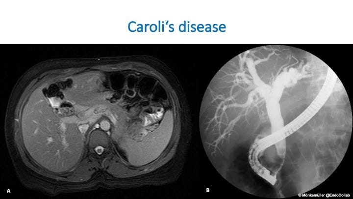 An Overview of Segmental Bile Duct Dilation and Caroli's Disease ...